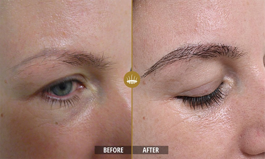 Hair transplantation scars and burn wounds - Hair Science Clinic