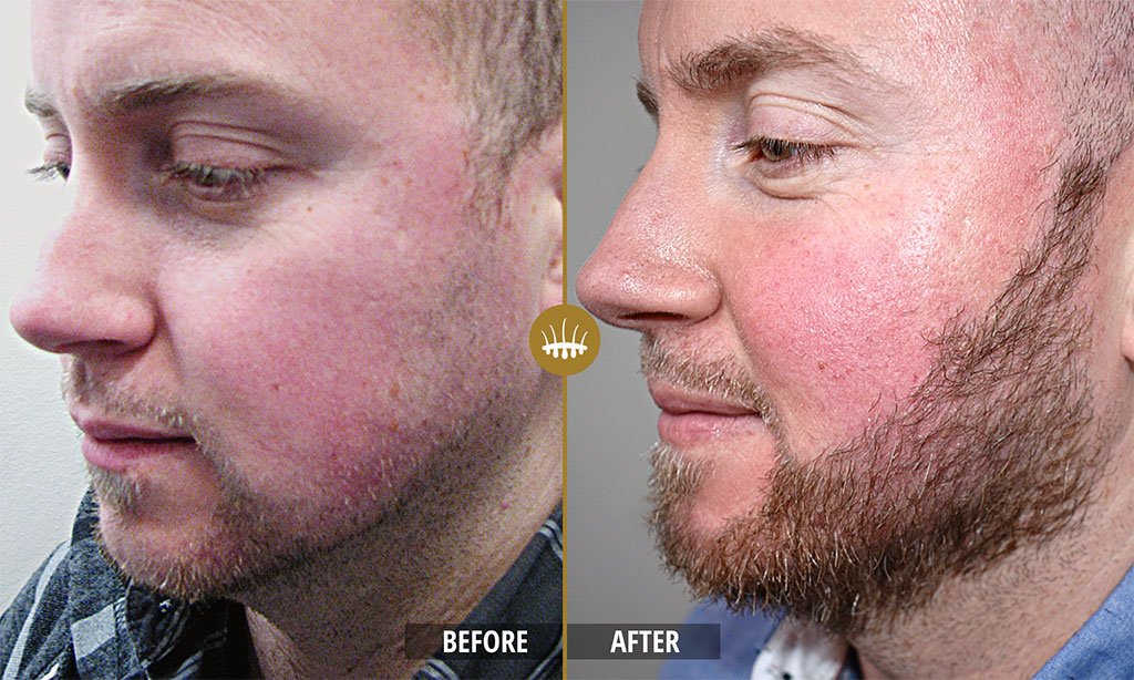 Hair transplantation scars and burn wounds - Hair Science Clinic