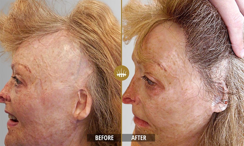 Hair transplantation scars and burn wounds - Hair Science Clinic