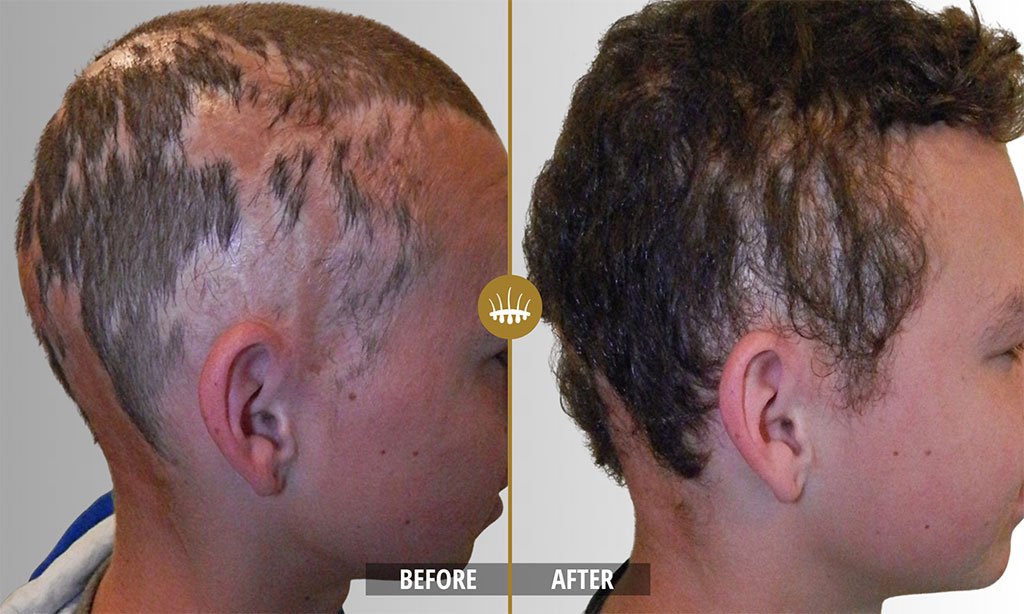 Hair transplantation scars and burn wounds - Hair Science Clinic