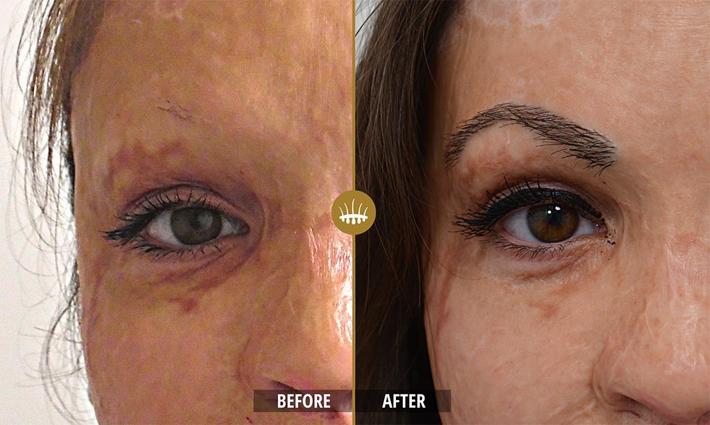 Hair transplantation scars and burn wounds - Hair Science Clinic